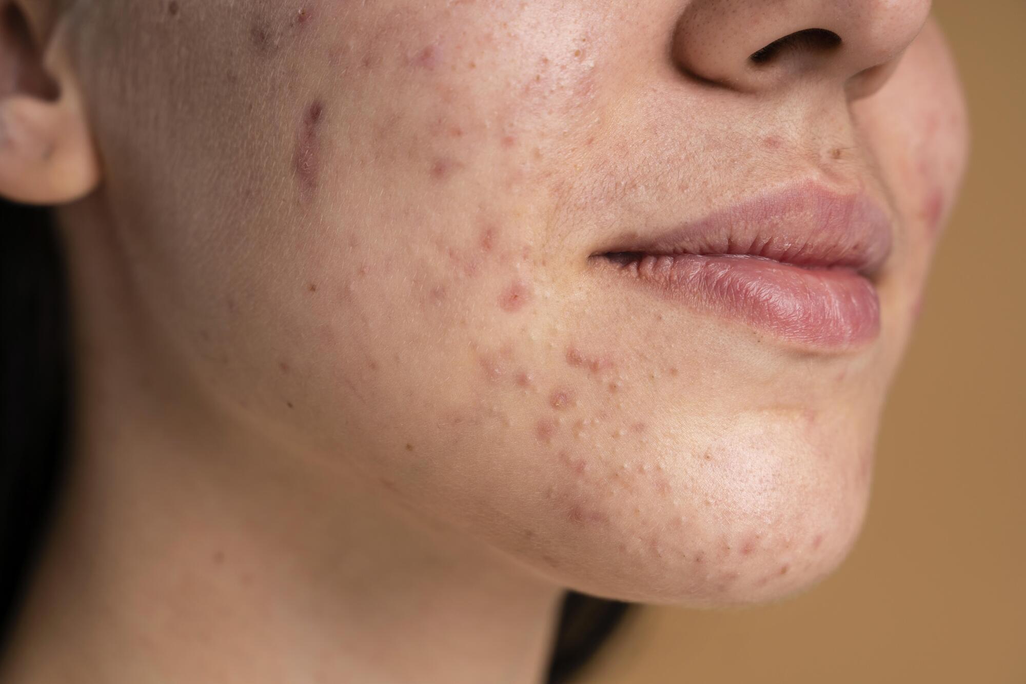 Blog | Skin | Melasma Skin Pigmentation Causes And Treatment | Cura Cliniq